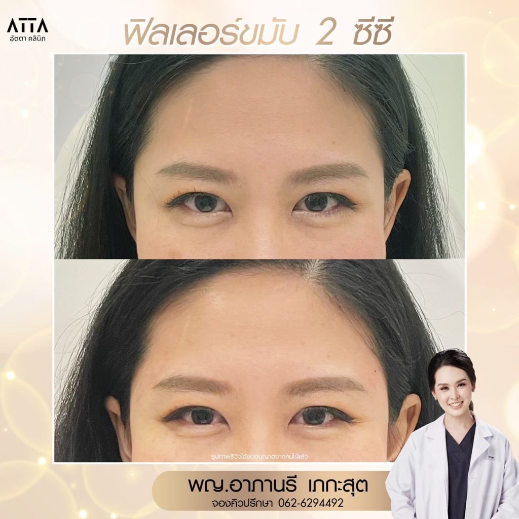 รีวิวฟิลเลอร์ขมับ - ATTA Clinic